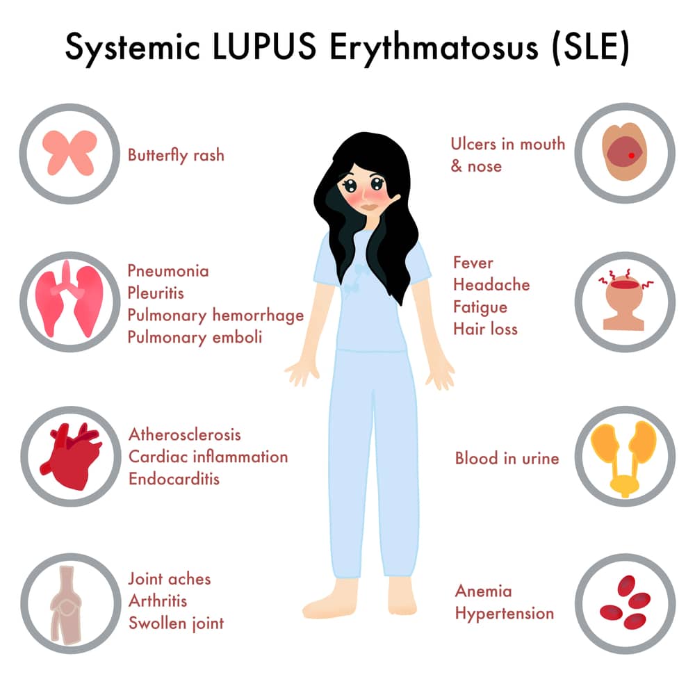 Systemic Lupus Erythematosus (SLE) • Bariboost