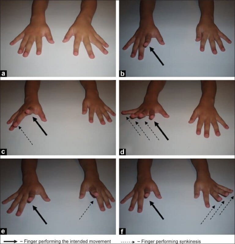 Mirror Movement Disorder (MMD)- A Case Study. • Bariboost