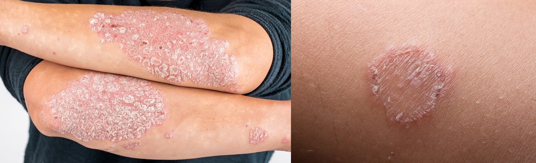 Is It Psoriasis Or Ringworm? • Bariboost