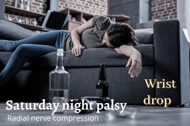Saturday Night Palsy (radial Nerve Compression) • Bariboost