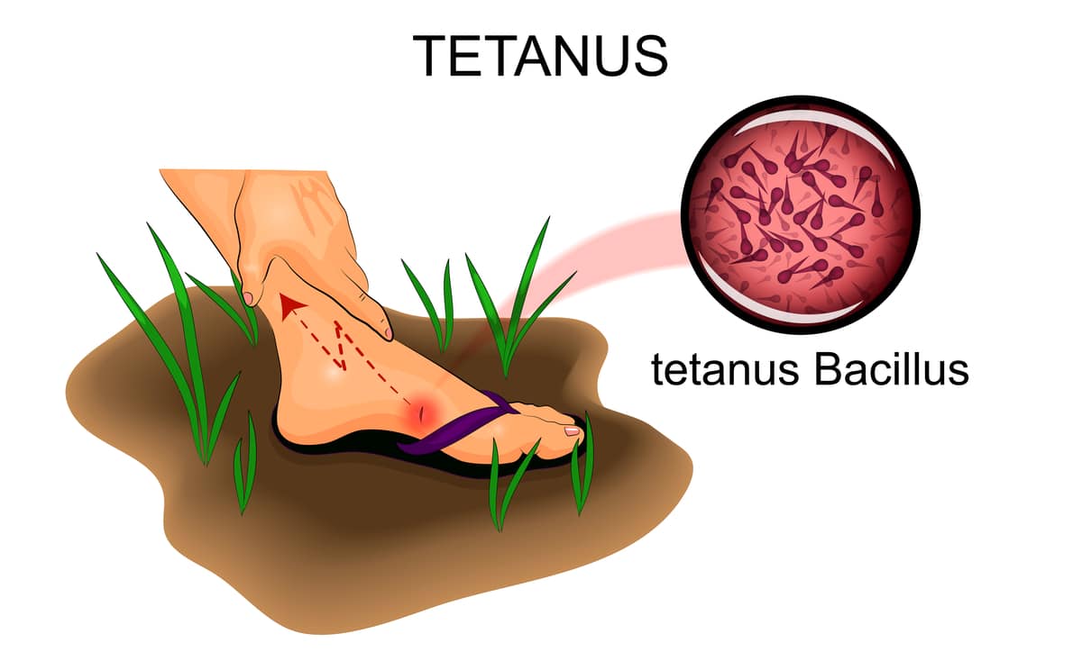 Tetanus: Dirty Wounds Aren't The Only Culprits • Bariboost